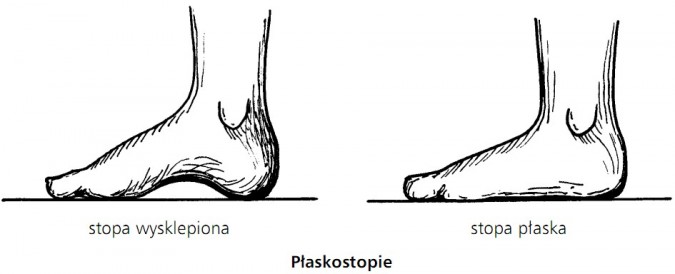 Układ ruchu, Wady w budowie szkieletu